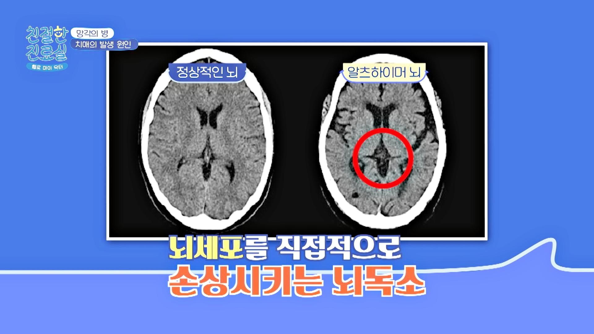 치매를 가속! 뇌세포를 직접적으로 훼손하는 뇌 독소😰 | JTBC 241202 방송 | ZUM TV
