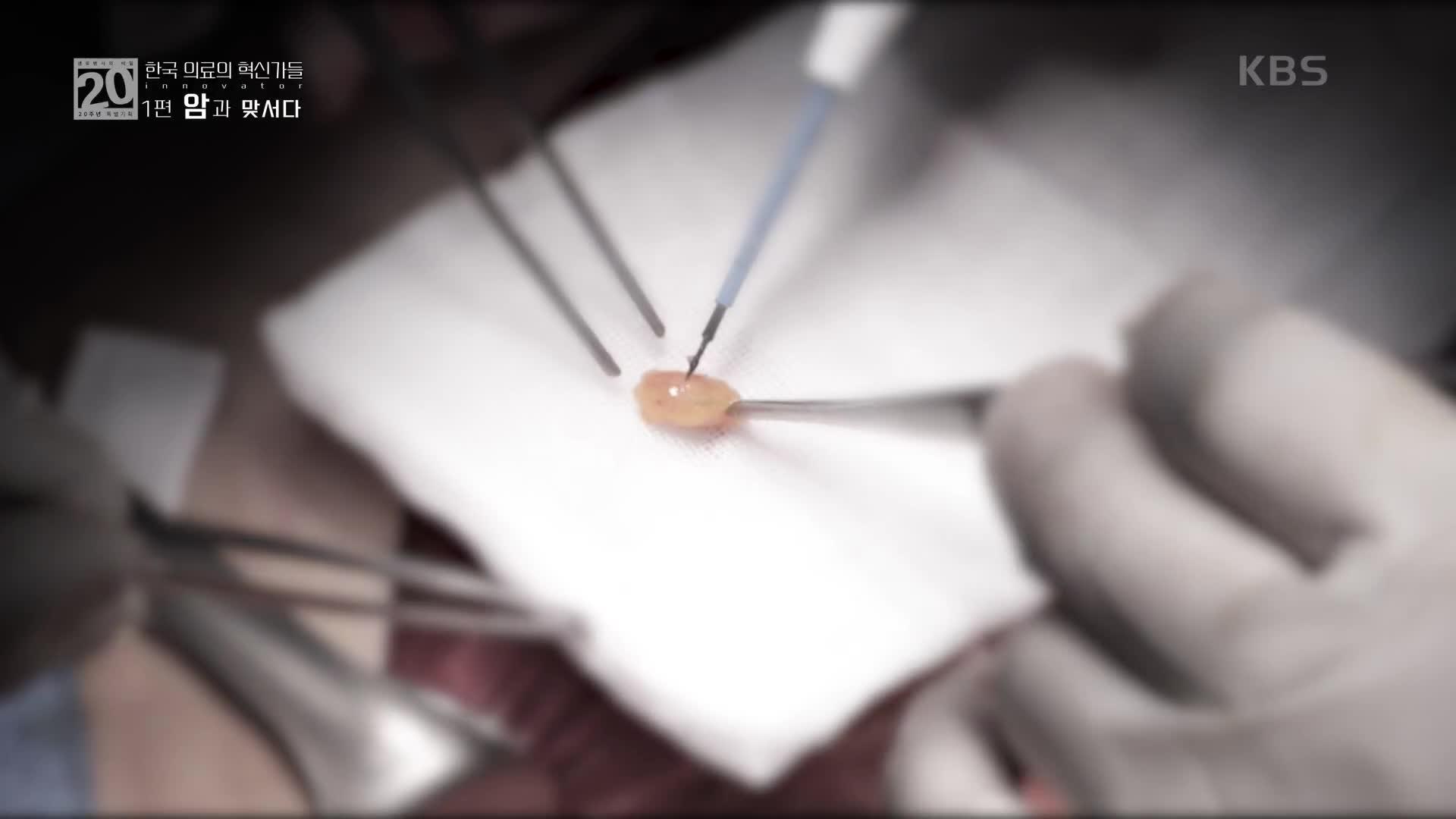 유방암치료의 혁신을 불러일으킨 감시 림프절 생검 | KBS 220105 방송 | ZUM TV