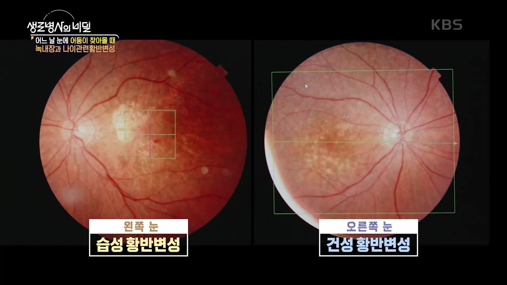 황반변성, 중심 시야가 사라진다! | KBS 250709 방송 | ZUM TV