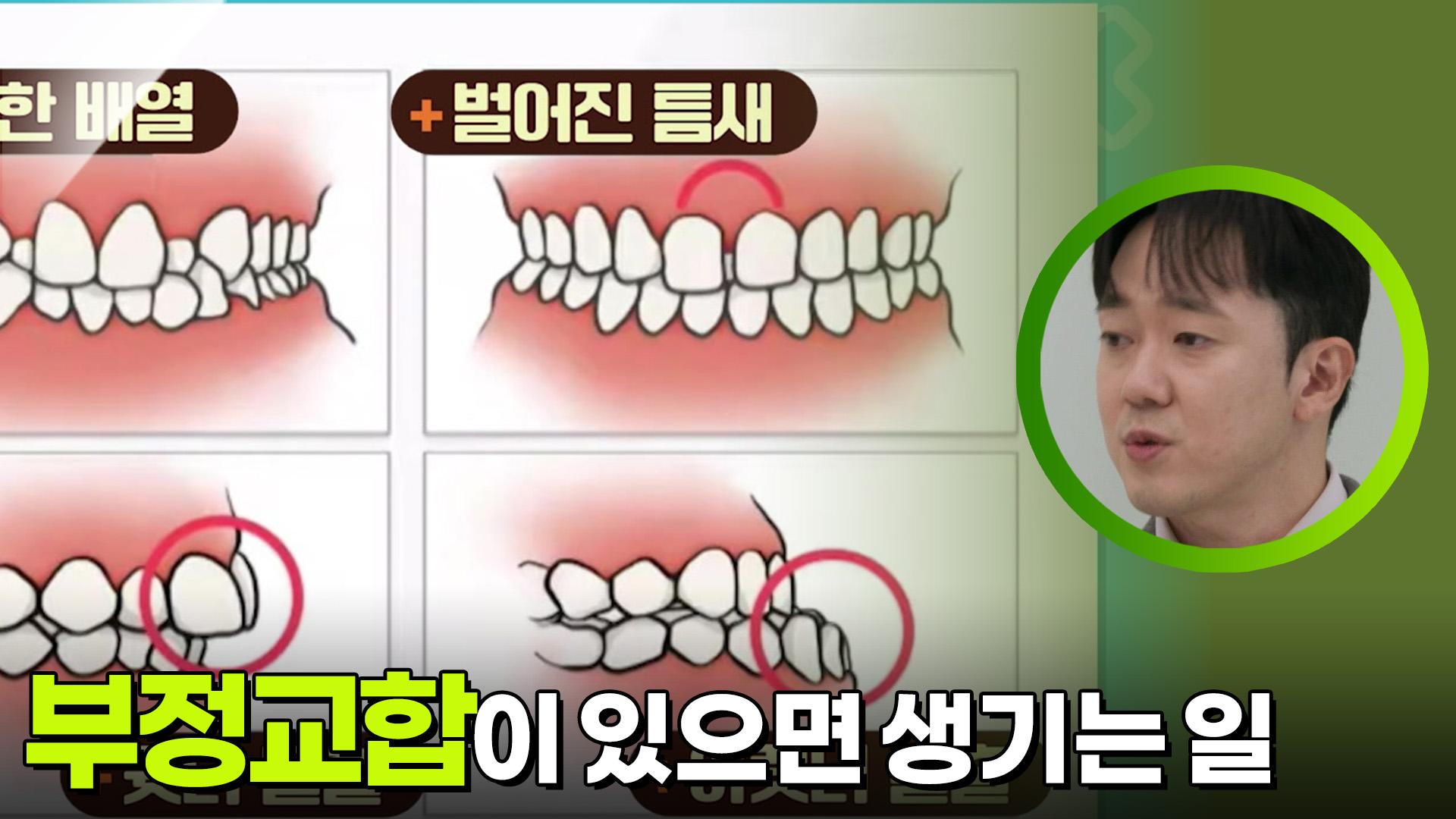 부정교합이 있으면 생기는 일들 | KBS 251123 방송 | ZUM TV