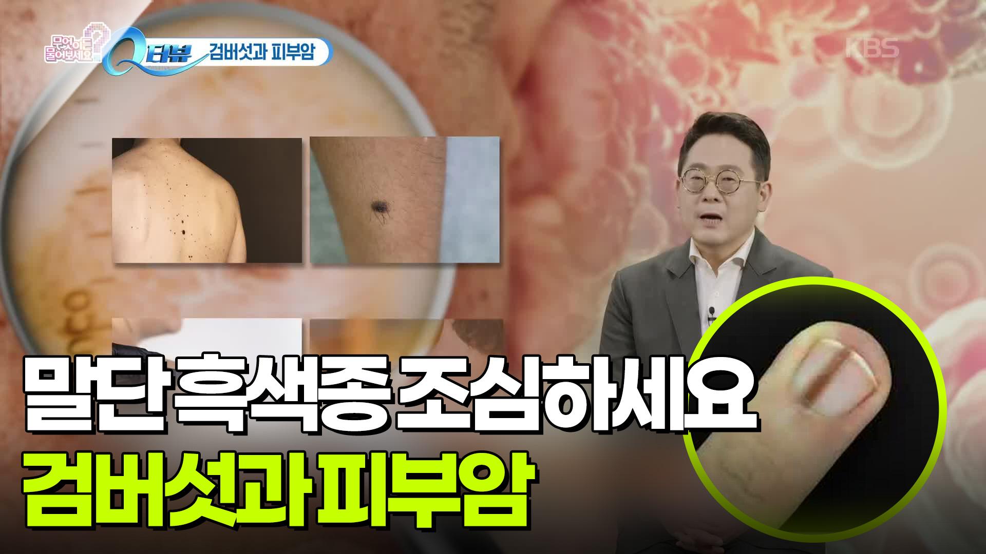 [Q터뷰] 검버섯과 피부암 어떻게 구분할까 | KBS 251127 방송 | ZUM TV