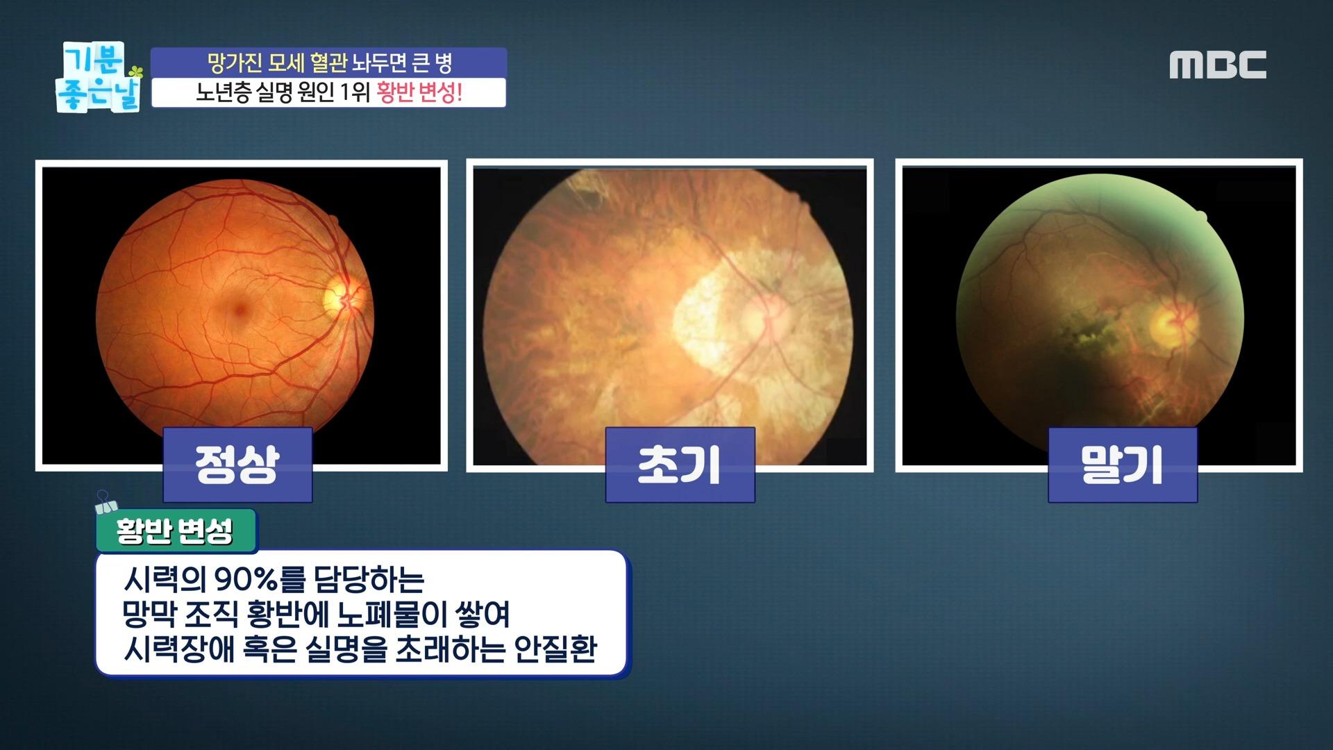 노년층 실명 원인 1위 황반 변성 Mbc 211119 방송 Zum Tv